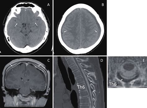 A B Initial Brain Ct Scan Shows Bilateral Csdh And Pseudo Sah C