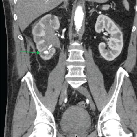Contrast Enhanced Abdominopelvic Ct Scan Showing The Arterial Phase