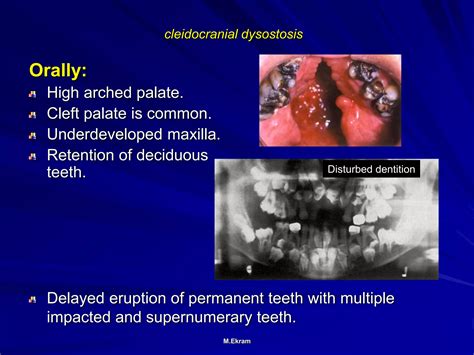 Common Syndromes Affecting The Head And Neck Ppt