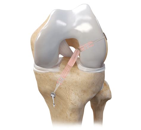 Arthrex Tightrope® Ii Rt Implant