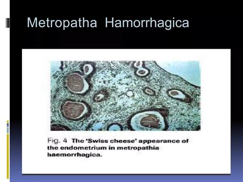 Abnormal Uterine Bleeding Ppt