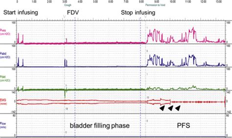 Urodynamics Testing Fairbanks Urology