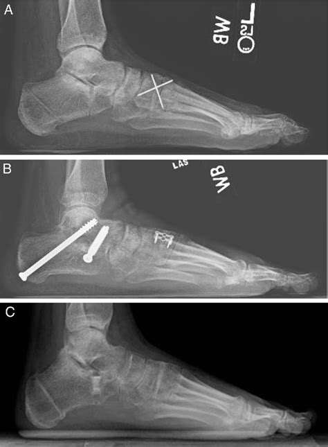 Figure 1 From Cotton Osteotomy In Flatfoot Reconstruction A Review Of