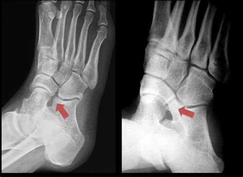 Tarsal Bones Xray