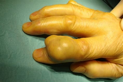 Maladie Des Doigts De La Main Et Maladie Du Pouce Pathologie Des