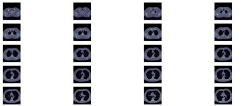 常见医疗扫描图像处理步骤 ct扫描的掩码 csdn博客