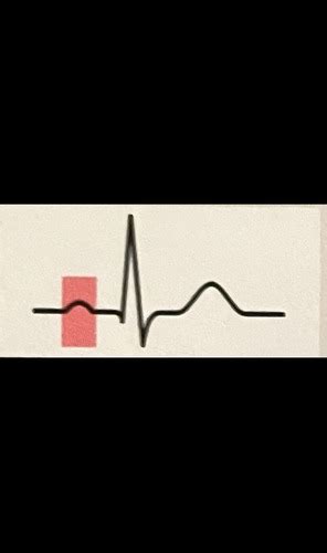 Basic Arrhythmias Book Flashcards Flashcards Quizlet