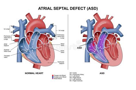 Atrial Septal Defect Asd Stock Illustration Illustration Of Organ