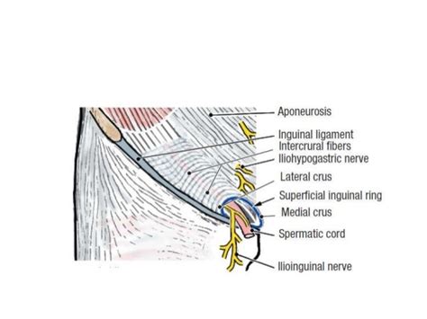 Ilioinguinal Nerve Inguinal Canal Ilioinguinal Nerve Inguinal Canal
