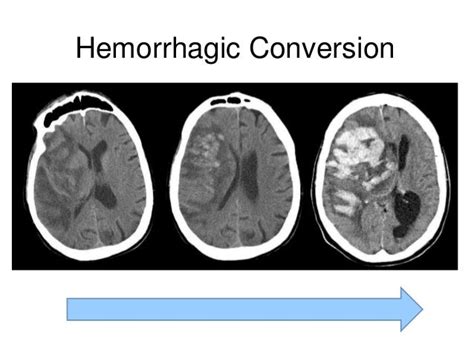 Stroke Overview Em Orientation