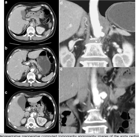 Figure 1 From Aortic Sarcoma Mimicking A Mycotic Aneurysm In The