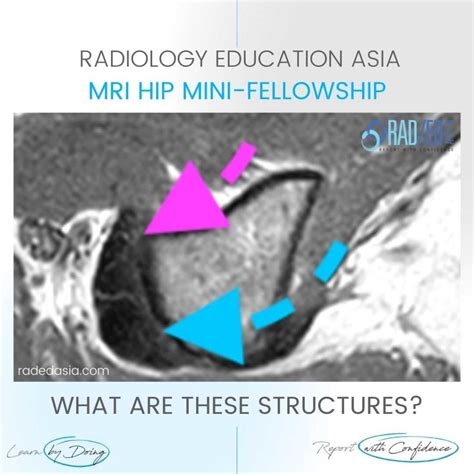 Hip Mri Hamstring Conjoint Tendon Origin Anatomy Radedasia