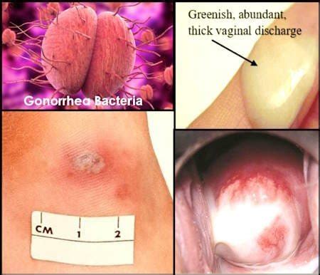 Gonorrhea In Females