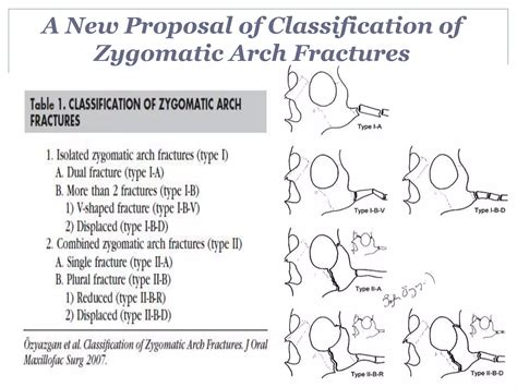 Zygomatic Complex Fracture Zmc Pptx