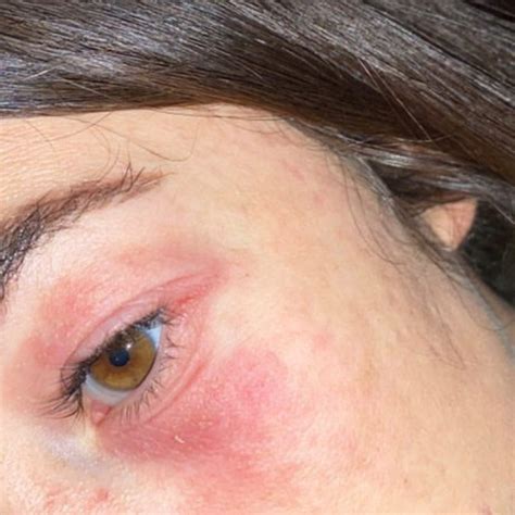 Witches Lab Uk The Reality Of How Painful Exzema On The