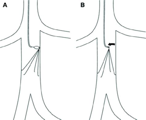 realignment technique loop snare with single access a curved guiding
