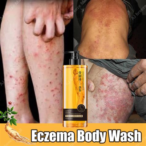 Eczema Body Wash Antibacterial Body Wash Ginseng Shower Gel Psoriasis