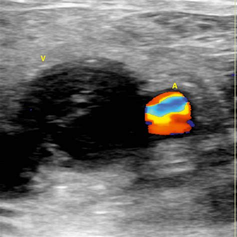 Acute Lower Extremity Deep Venous Thrombosis Presentation Diagnosis