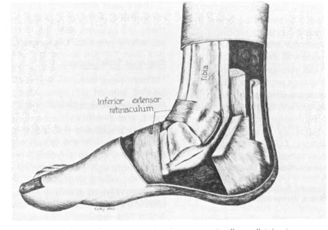 Figure 2 From Surgical Treatment Of Stenosing Tenosynovitis At The