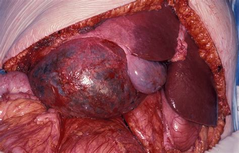 Cystic Liver Disease