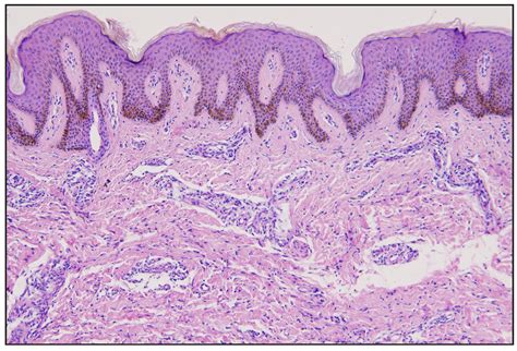 Clinicohistopathological Features And Outcome Of Cutaneous And Systemic