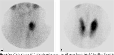 Figure 1 From A Case Of An Autonomously Functioning Thyroid Nodule Combined With Subacute
