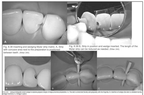 Class Iii Composite Resin Restoration Conservative And Extensive Flashcards Quizlet