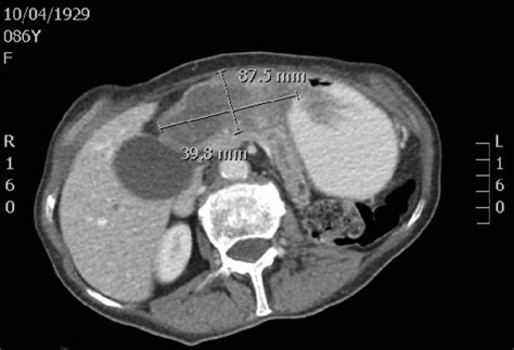 Prolapsed Fundic Gastric Polyp Causing Gastroduodenal Intussusception And Acute Pancreatitis Pmc