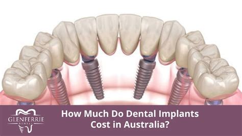 How Much Do Dental Implants Cost In Australia