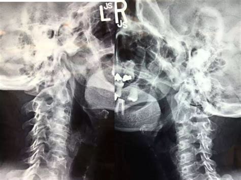 Posterior Cervical Facet Arthrosis Ppt