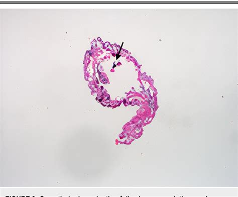 Figure 3 From Ultrasound Detection Of Human Botfly Myiasis Of The Scalp
