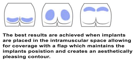 Buttock Augmentation Cosmetic Surgery Holidays In Malaysia And Thailand