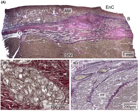 Moderator Band Histology