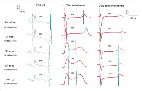 Figure 1 From Prolonged Repolarization In The Early Phase Of Ischemia
