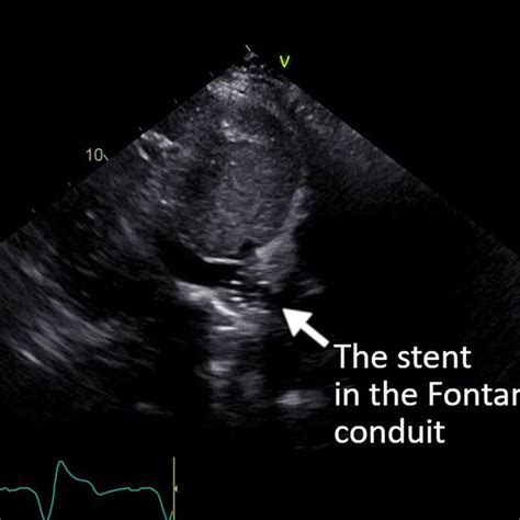 Fontan Conduit Angiography Before Stenting A Narrow 11 2 Mm