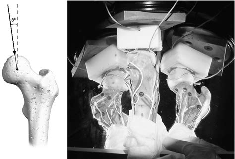 Figure 1 From Subject Specific Finite Element Models Implementing A Maximum Principal Strain