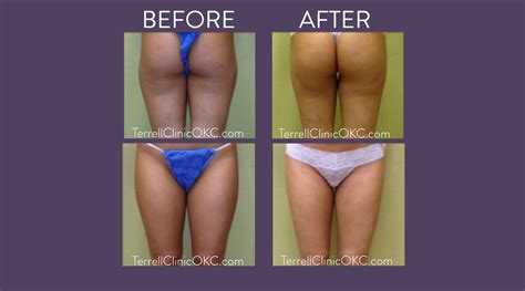 Liposuction Inner Thighs