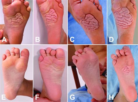 Progressive Overgrowth Of The Cerebriform Connective Tissue Nevus In