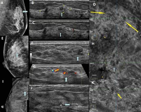 A D 46y Female A Patchy Distribution Of Amorphous Calcification In Download Scientific
