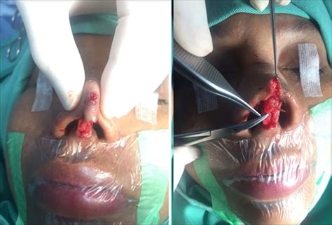 Threads In Rhinoplasty To Thread Or Not To Thread The Pmfa Journal