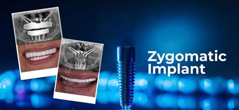 Zygomatic Dental Implant Zygoma Implant