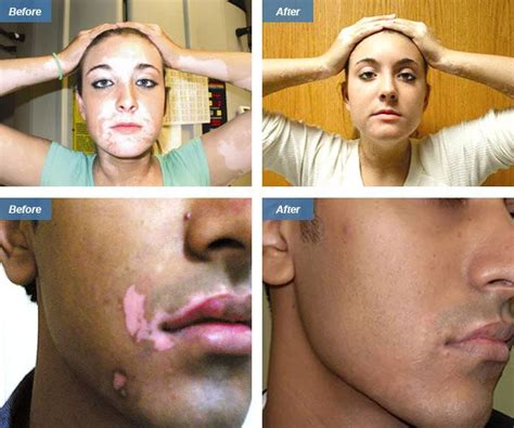 Excimer Laser — Diane Baird Md Pc Dermatology