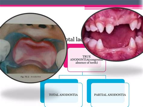 Developmental Disturbances Of Teeth Ppt