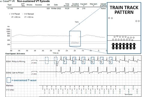 Figure 1 From T Wave Oversensing With Contemporary Implantable