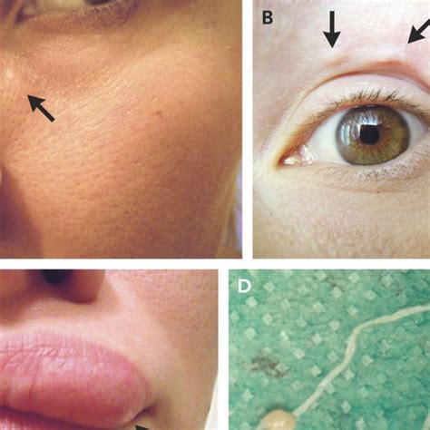 Worms On Face Skin