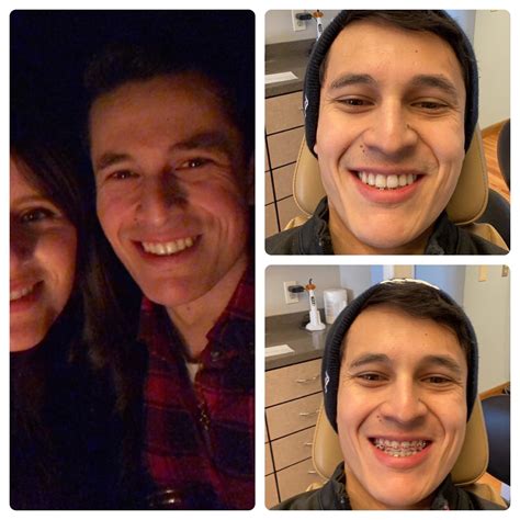 Got My Braces Off Last Week Cant Stop Smiling Haha R Gaymersgonemild