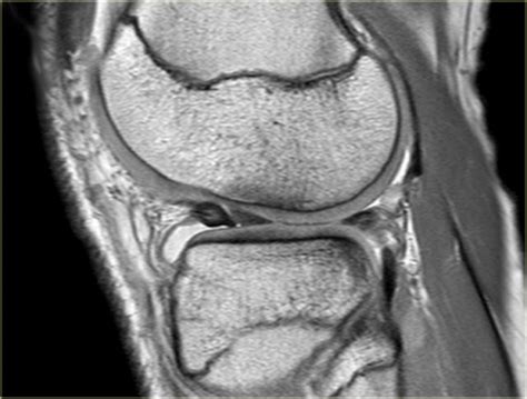 The Radiology Assistant Meniscus Special Cases