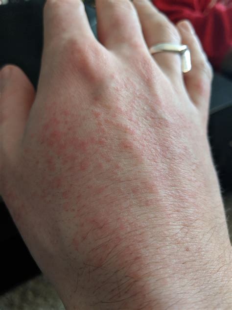 Rashes On Hands Only Common Foot Rashes Symptoms Causes And