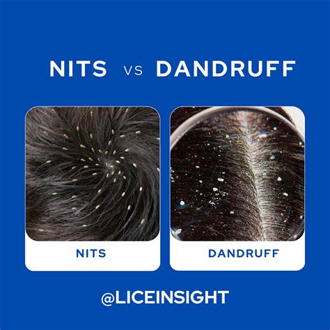 Nits Vs Dandruff