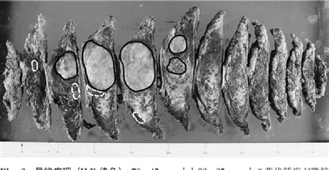 Figure 1 From A Case Of Borderline Phyllodes Tumor Of The Breast That